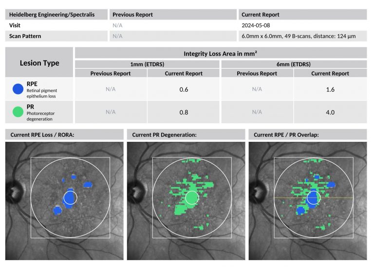 KI zur Diagnostik bei trockener Makuladegeneration implementiert